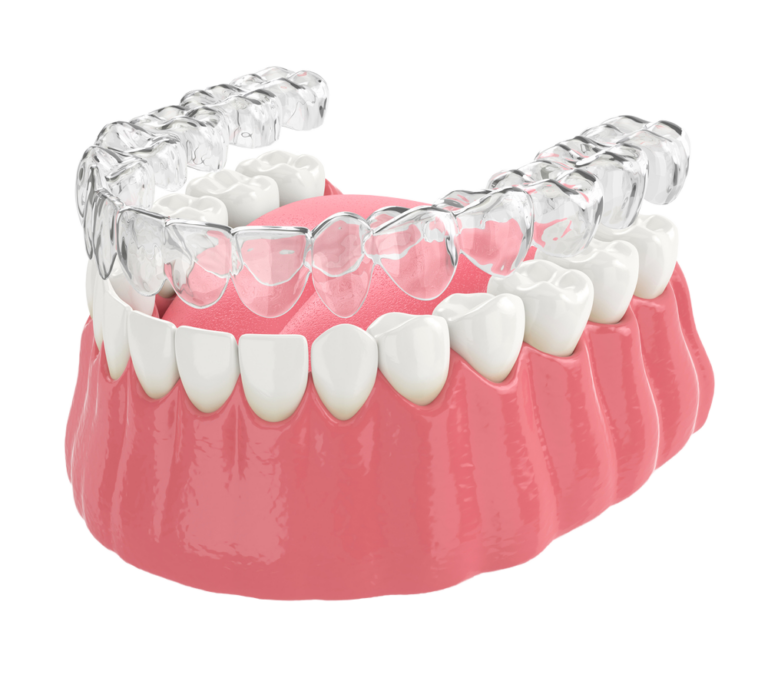 Invisalign / Teeth Straightening - Sharples Dental Practice